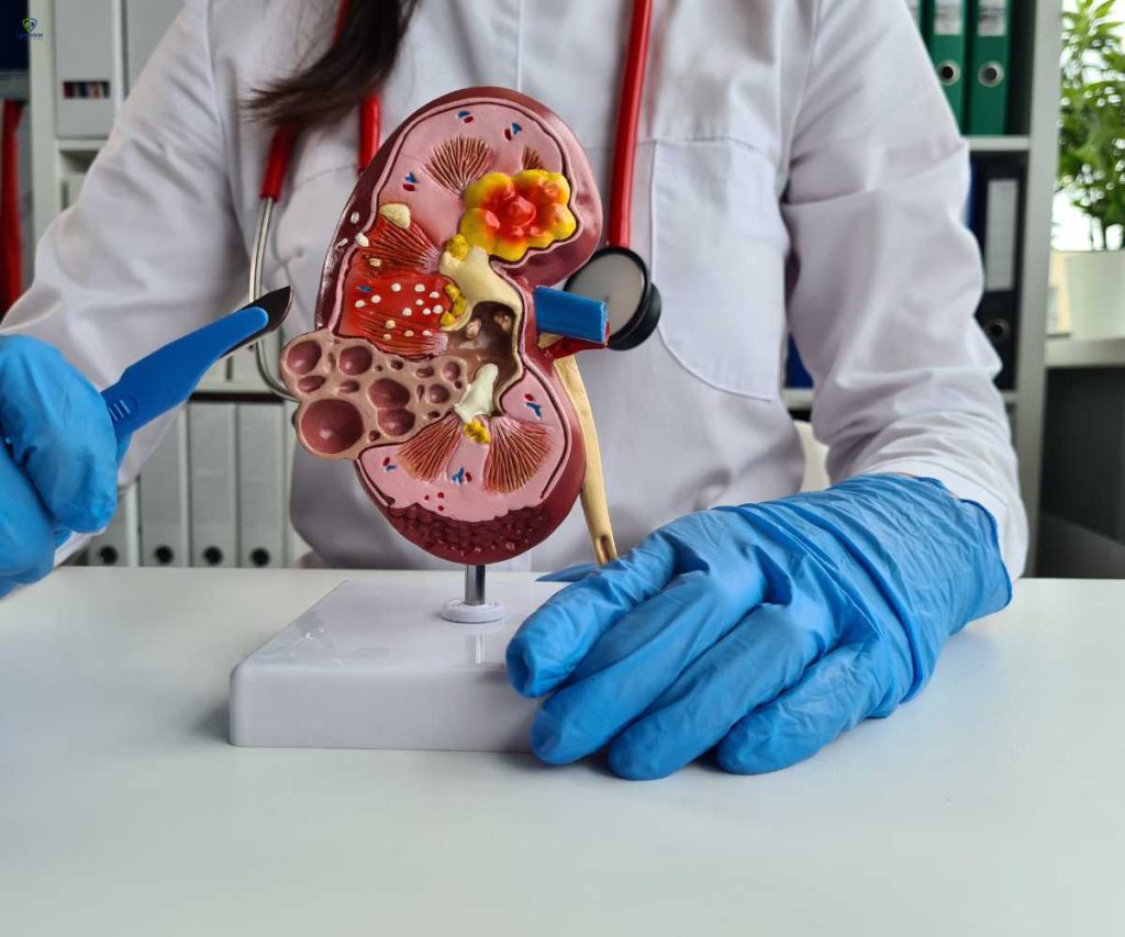 Lithotripsy for Breaking Kidney Stones – Lakeview Center for Urology